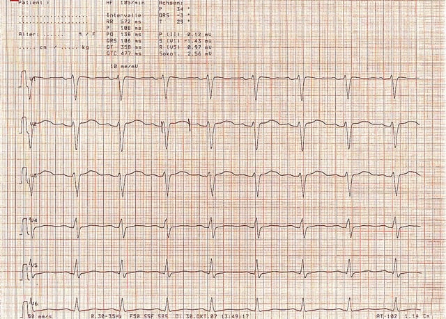 Twoje serce pod czujnym okiem Apple. Czy smartwatch wykryje nadchodzący zawał?